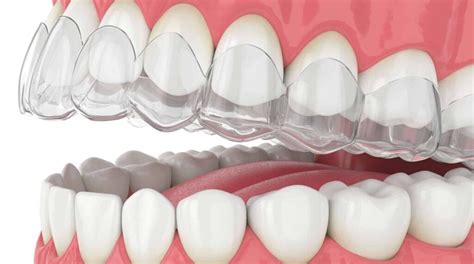 The Pros And Cons Of Essix Retainers Absolute Dental