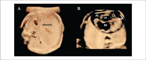 Spatio Temporal Image Correlation Three Dimensional Imaging For Fetal Cardiac Screening And