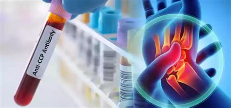 Anti Ccp Antibody Test A Complete Guide Regarding Test Procedure Preparation And Cost