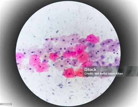 Hpv 관련 변화가있는 염증성 도말을 보여주는 현미경 검사에서 자궁 경부 세포진 검사 자궁 경부암 증권 시세 표시기 사람유두종바이러스에 대한 스톡 사진 및 기타 이미지