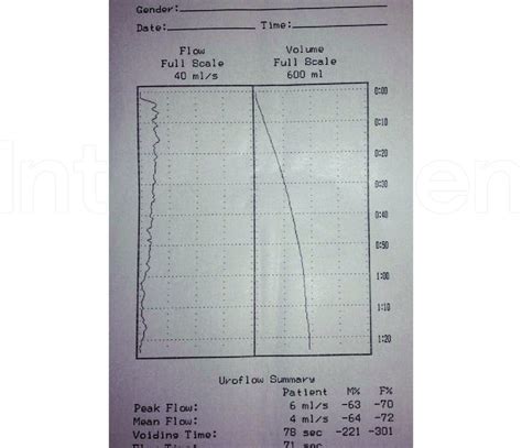 En Plateau Obstructive Uroflow In A Patient With Anterior Urethral Download Scientific