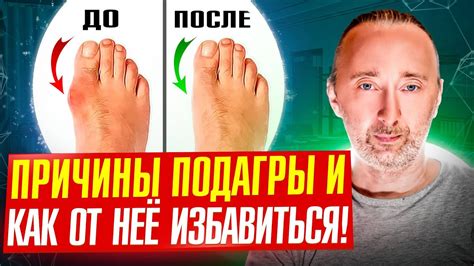 ПОДАГРА? Её НЕ будет! Причины подагры и её лечение! - YouTube
