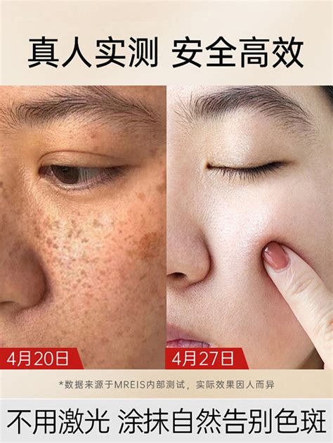 祛斑霜美白淡化色斑男女神器淡斑去斑祛黄褐斑雀斑老年斑官方正品 Tmallhk天猫国际