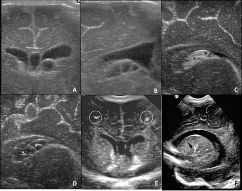 Table 1 From From Fetal To Neonatal Neuroimaging In Torch Infections A Pictorial Review