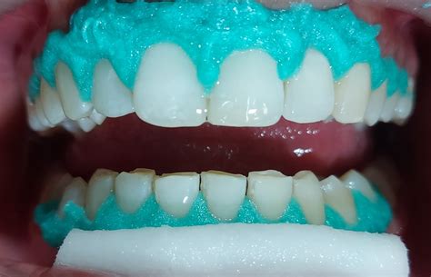 Teeth Whitening Dr Gargs Clinic