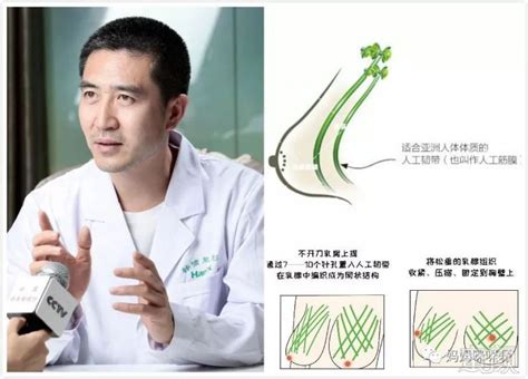 乳房下垂原因众多矫正担心疤痕怎么办 蜜颜优惠