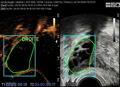 Ultrasound Acquisition In Contrast Enhanced Ultrasound Download