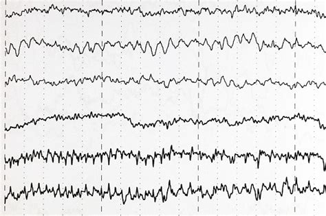 뇌 파 뇌 파의 소아 환자 뇌의 전기 활동에 문제에 뇌 파 패턴 건강관리와 의술에 대한 스톡 사진 및 기타 이미지 건강관리와 의술 과학 그래프 Istock