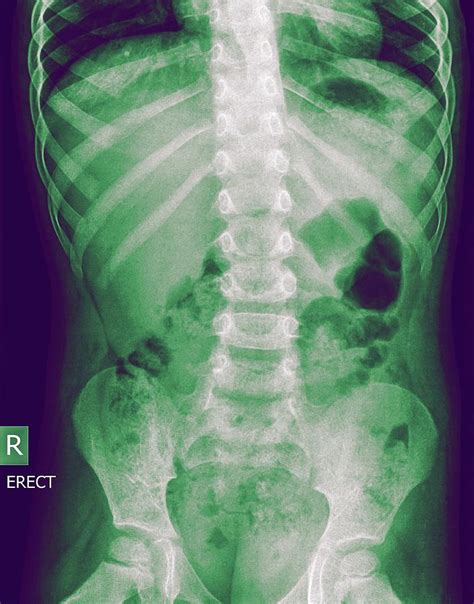 Abdomen X Ray Photograph By Photostock Israel Pixels