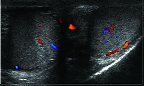 Imaging Testicular Torsion Applied Radiology