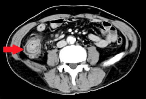 Abdominal Computed Tomography Ct Showing The Target Lesion With Download Scientific Diagram