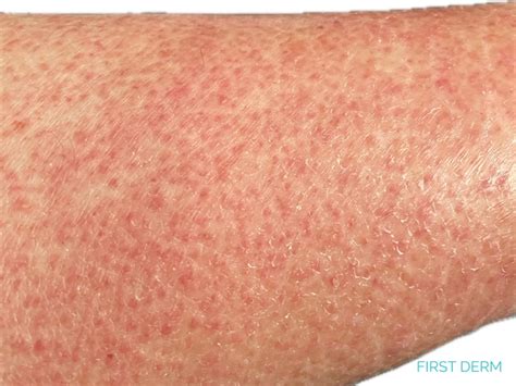 Drug Rash Pictures Symptoms Diagnosis And Treatment