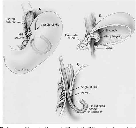 Hiatal Hernia Repair Laparoscopic