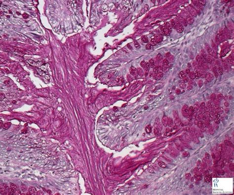 Viscous Digestive Mucus Human Pathology