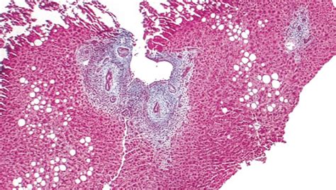 Primary Sclerosing Cholangitis Histology