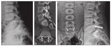 Pars Interarticularis Fractures Treated With Minimally Invasive Surgery A Literature Review Pmc
