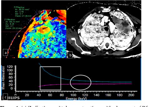 Figure 1 From Dual Layer Spectral Ct As Innovative Imaging Guidance In Lung Biopsies Could