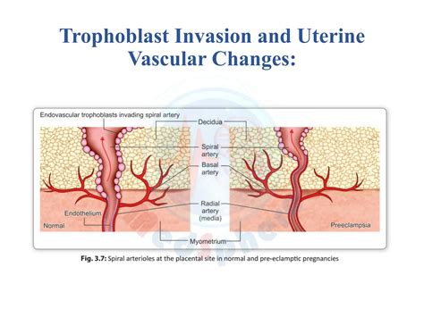 Moins Medical Lecture 3htn In Pregnancy 1pdf