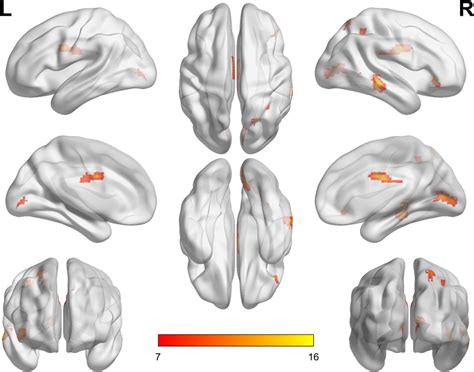 Differences In The Functional Connectivity Of The Right Caudate Nucleus Download Scientific