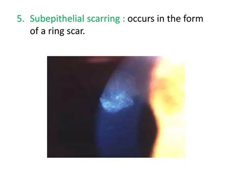 Allergic Conjunctivitis Ppt