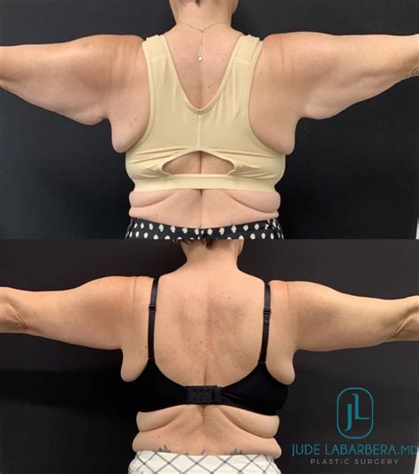 Arm Procedure Case Number A Before After Results