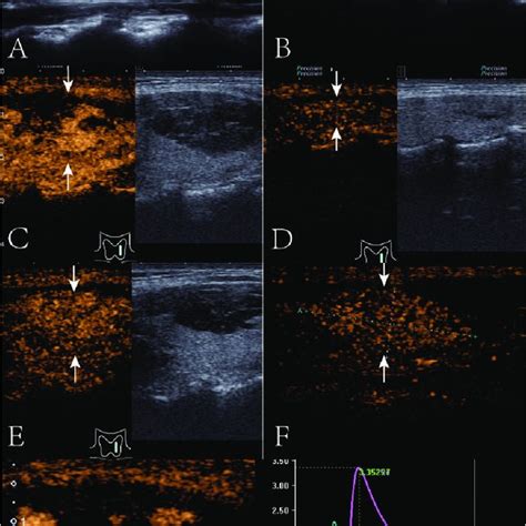 Microscopic View Of The Thyroid Hemangioma A The Lesion Consisted Of