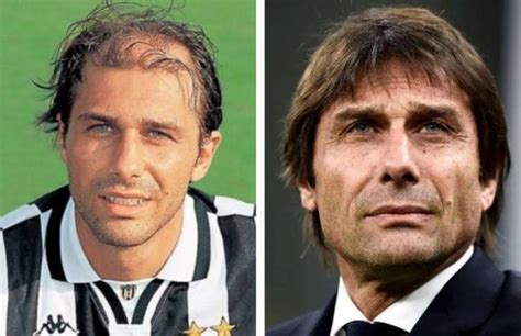 23 Footballer Hair Transplants And Transformations Wimpole Clinic