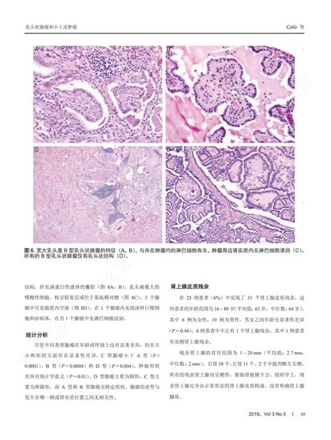 美国外科病理学杂志 肾脏乳头状腺瘤和其他小的上皮性肿瘤尸检研究 Of