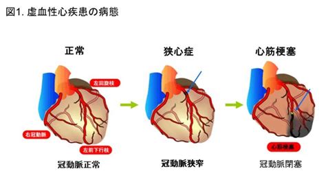 コラム No 15 心血管疾患予防に向けた生活習慣の最適化 医療・医学なんでもコラム 荻窪の内科・循環器内科・小児科【百瀬医院】