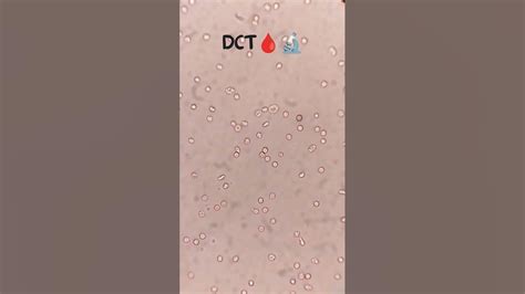 Direct Coombs Test Result Under Microscopehematology Medical