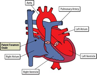 Patent Foramen Ovale Pfo Centennial Heart Cardiovascular Consultants