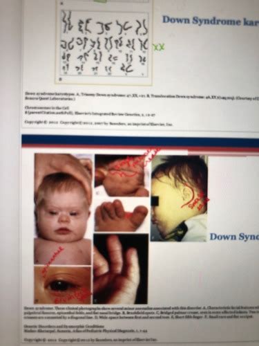 Chromosome Disorders Flashcards Quizlet