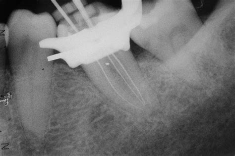 Ask Drm Another C Shaped Canal