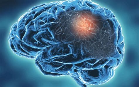 Forearm Neurological Disorders Causes Symptoms And Care