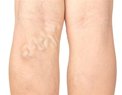 What Is Vein Mapping The Vein Center Of Maryland