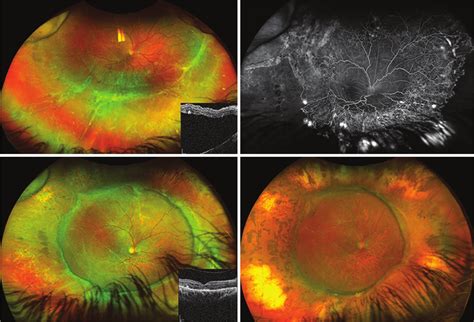 Adult Retinopathy Of Prematurity With Rhegmatogenous Retinal Download Scientific Diagram