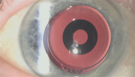 Cataract Surgery And Amd What You Need To Know Mivision