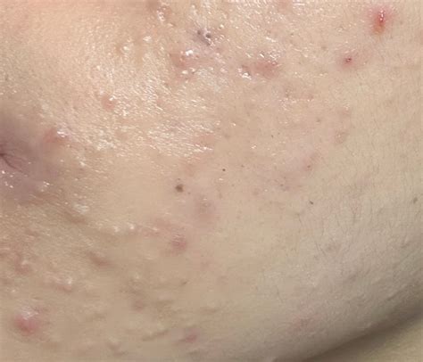 여드름 관리법 질문 지식in