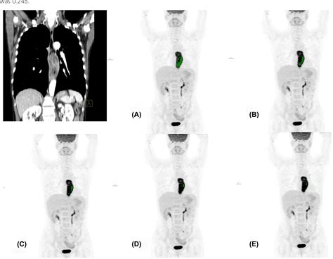 Figure 1 From Determination Of Regional Lymph Node Status Using 18f