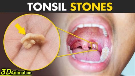 Tonsil Stones How Tonsil Stones Form In Our Tonsils Tonsilloliths
