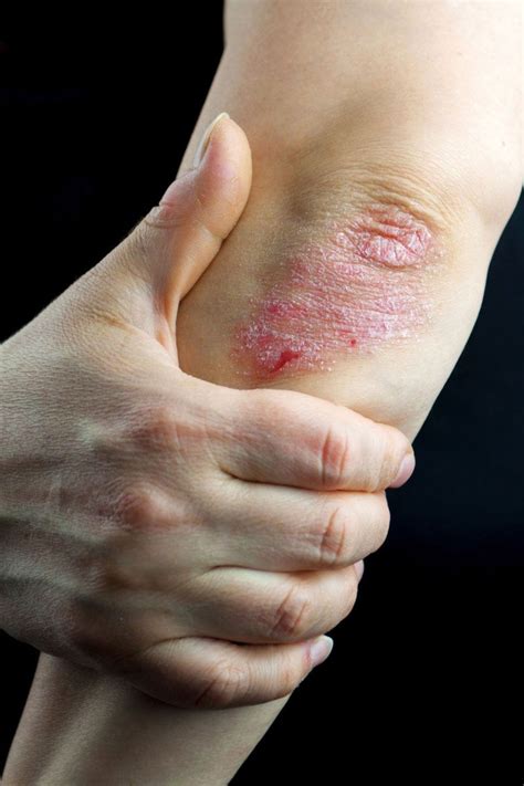 Psoriasis Symptoms Causes Treatments Psoriasis Symptoms Autoimmune