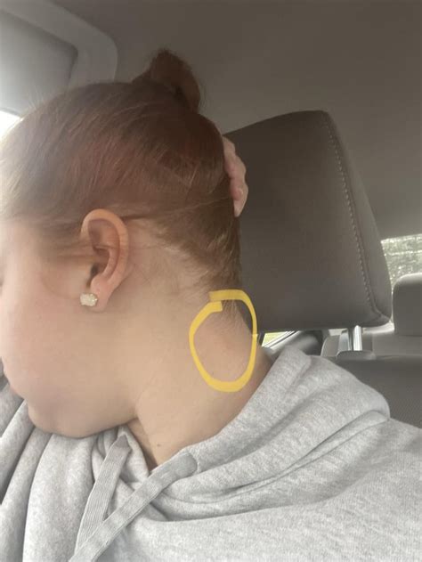 Lymph Node R Lymphnodes