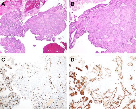 Papillary Neoplasms Of The Breast Surgical Pathology Clinics