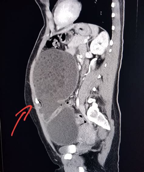 Abdomen Ct Sagittal Extremely Large Benign Ovarian Mass Dermoid With Fat And