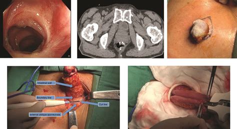Loop Ileostomy Closure Diseases Of The Colon Rectum