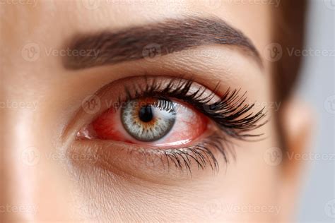 Woman Experiencing Red Eye Irritation And Conjunctivitis 73276204 Stock