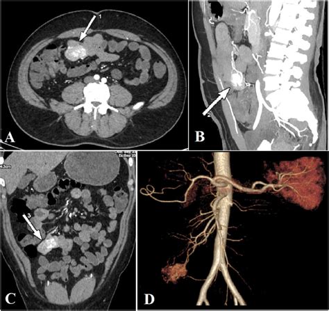 A B And C Triphasic Pelviabdominal Cross Sectional Sagittal And