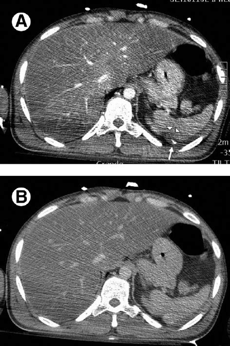 Value Of Multiphasic Computed Tomography Ct Evaluation In The