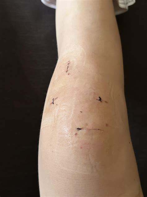 What Are The Respective Scars For Quad Graft R Acl