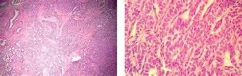 A Storiform Fibrosis Around The Small Pancreatic Duct Hematoxylin